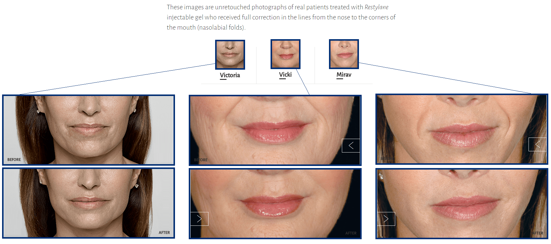 Restylane | Dermal Injectable Filler | Essent Spa and Medical Spa